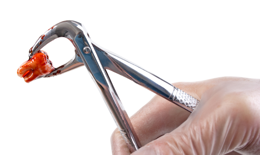 Managing Bleeding After Tooth Extraction What To Do Managing Bleeding After Tooth Extraction What To Do